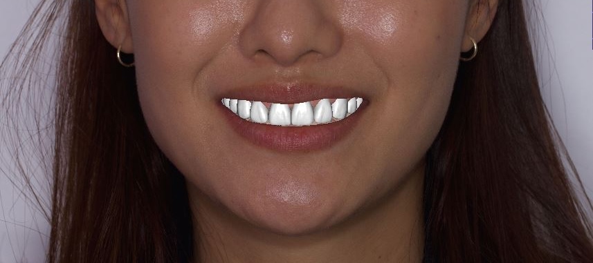 Digital Wax-up | Vanguard Computer Assisted Laboratory