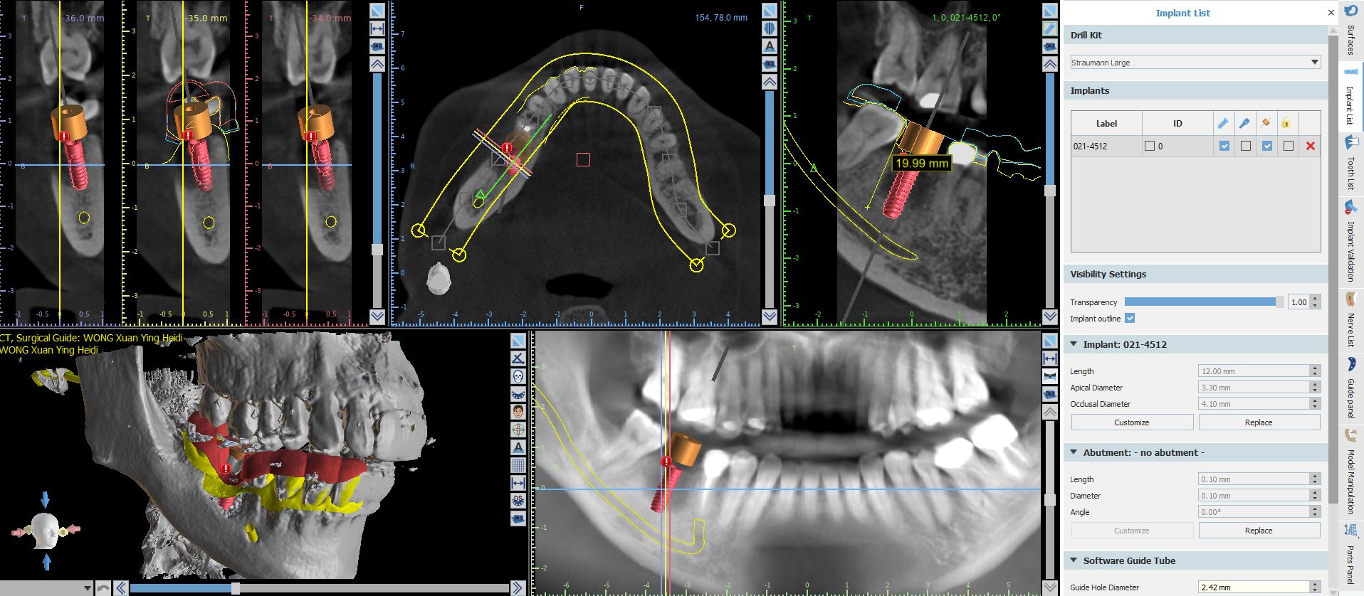 Surgical Guide | Vanguard Computer Assisted Laboratory